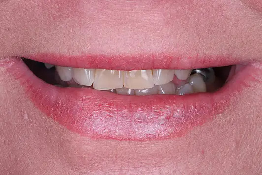 Dental Bridge and Dental Crown - Harris Dental Boutique